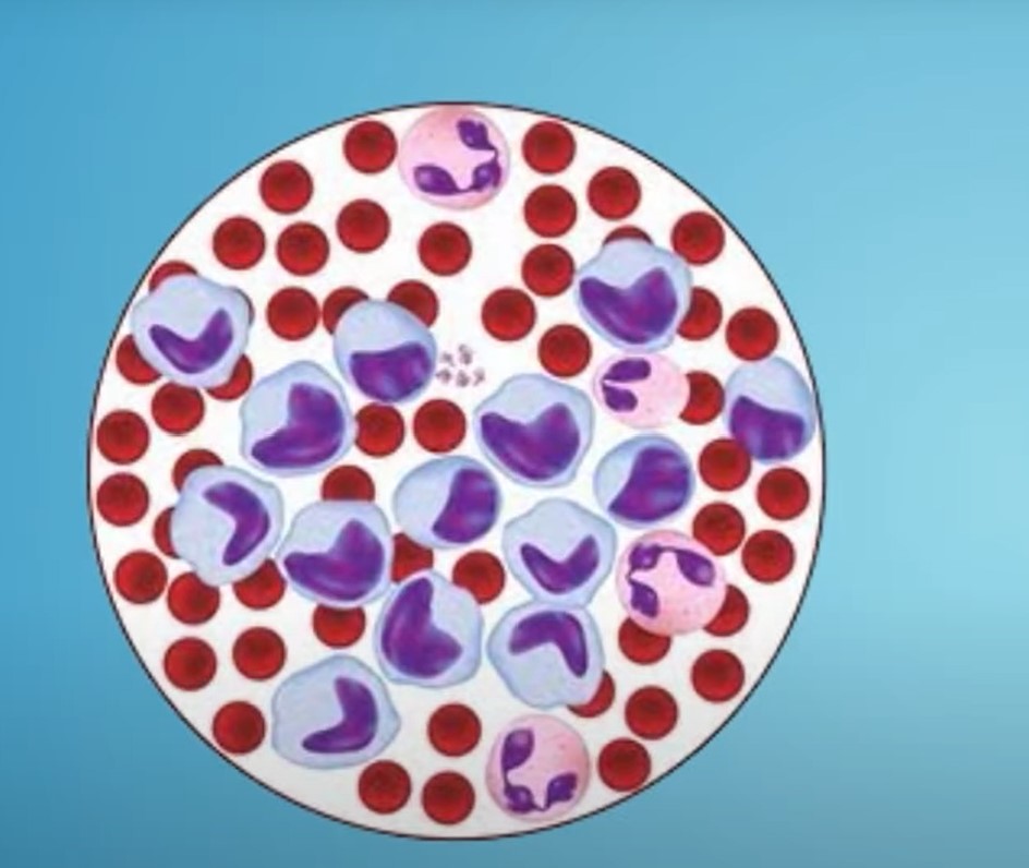 Public Can’t Spot Leukaemia Symptoms | The Fabricator